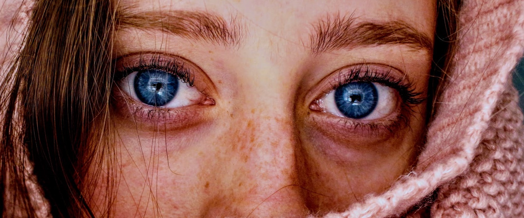 Svetovni dan psoriaze - Med.Over.Net