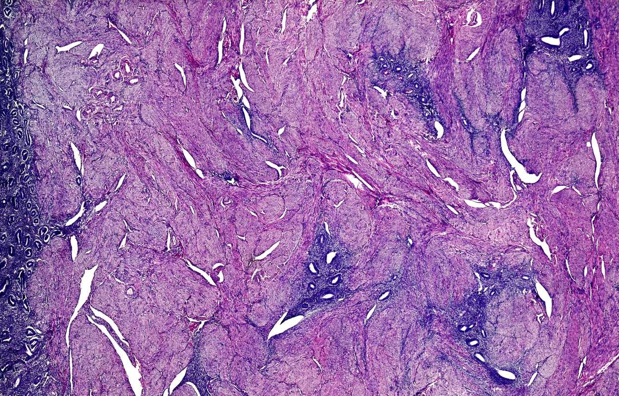 Zdravljenje endometrioze: nove ugotovitve lahko premaknejo način ...