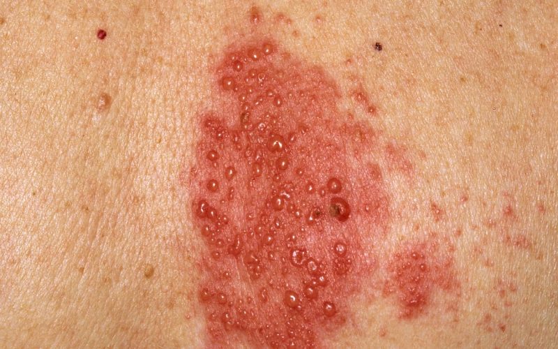 Bralka: "Še dobro, da sem poguglala simptome" - Med.Over.Net