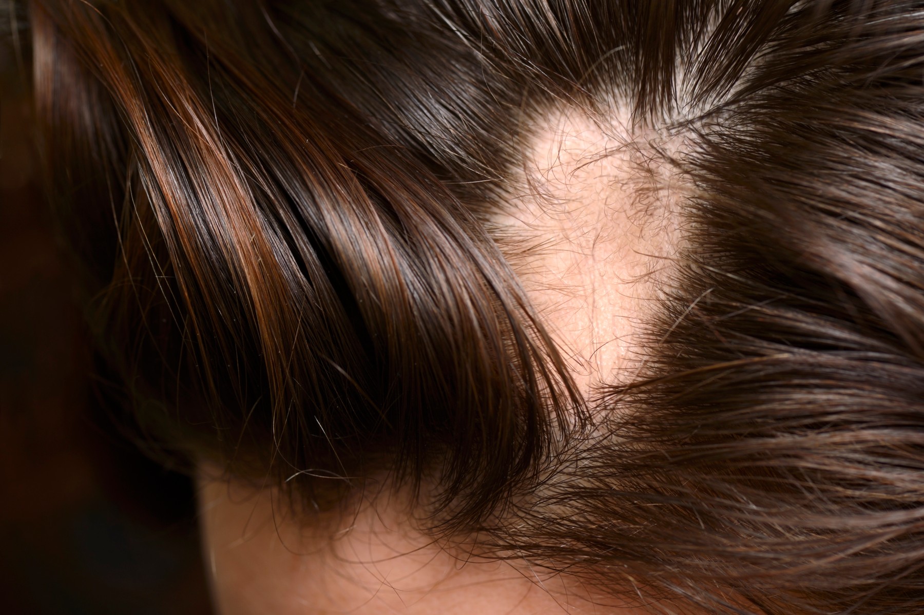 Zaradi tega vam lahko izpadajo lasje - Med.Over.Net