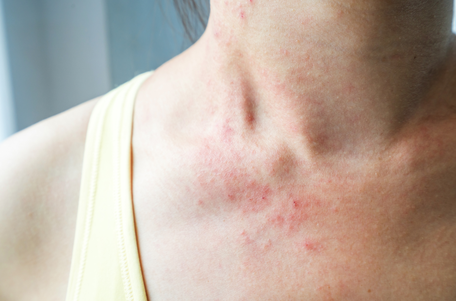 PERIORALNI DERMATITIS? - Med.Over.Net - Dermatologija