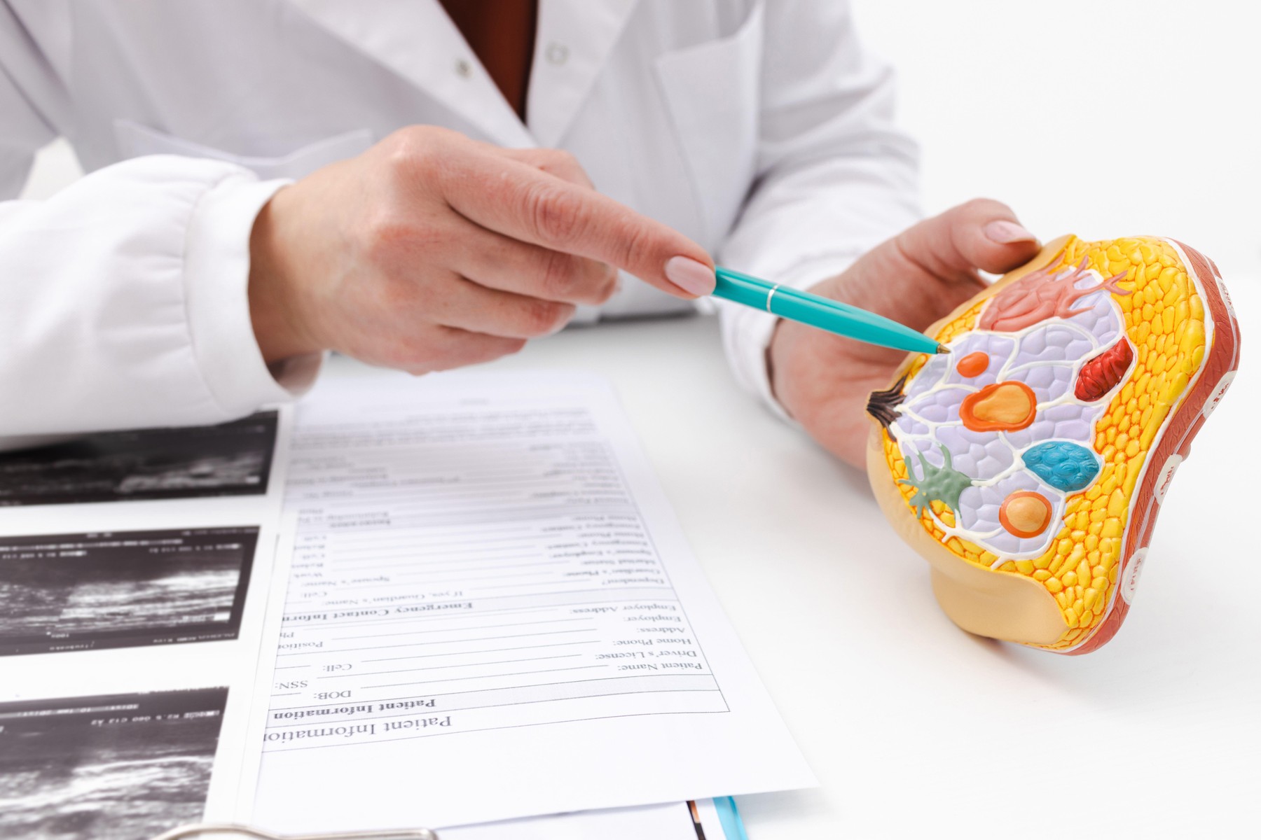 Trojno negativni rak dojk: Bolj agresivna oblika, ki se rada ponavlja ...